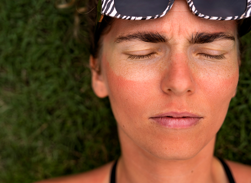 Prvá pomoc pri úpale a úpale: Čo robiť krok za krokom | Natima